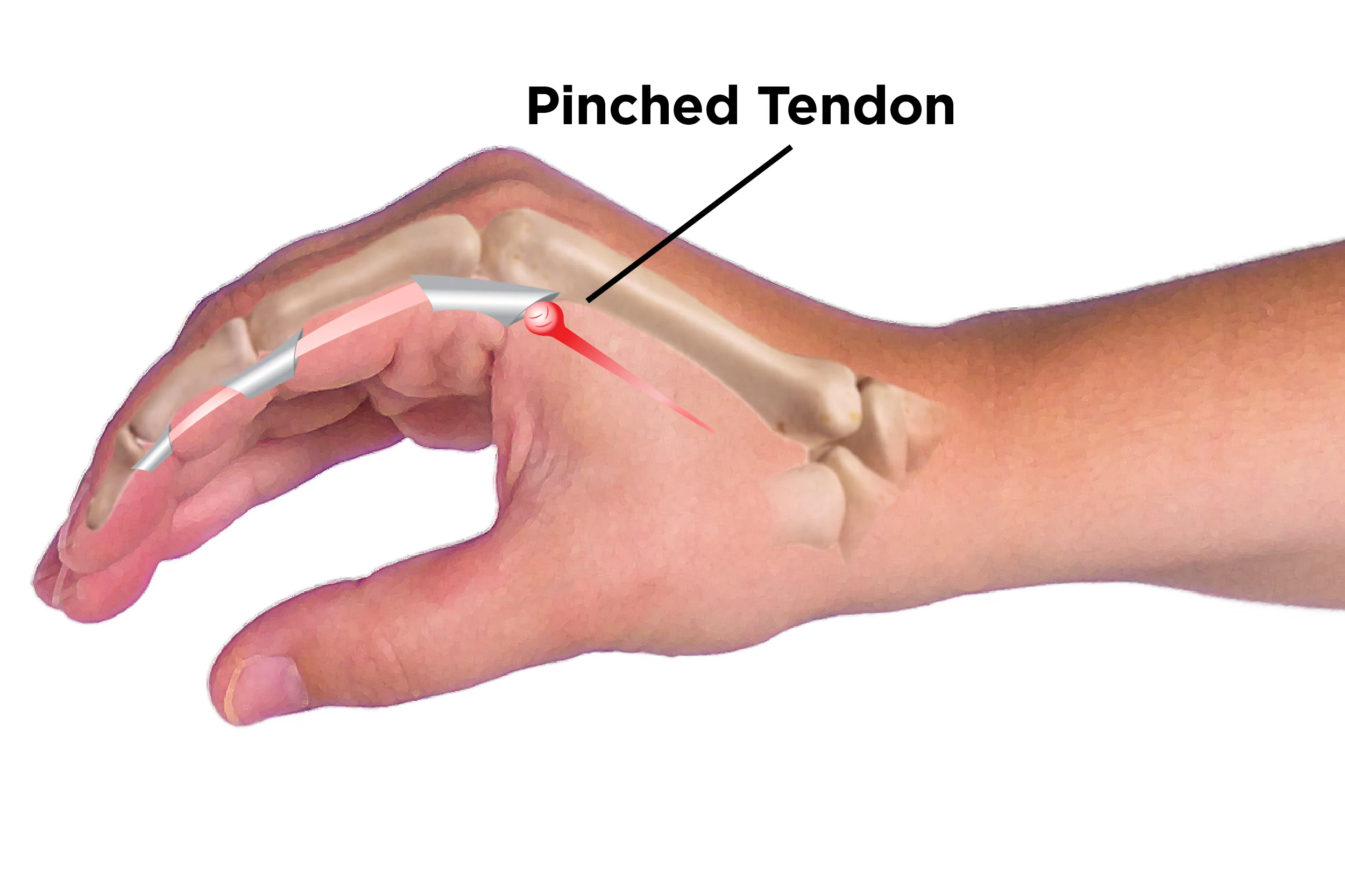 Best Trigger Finger Treatment In Gurgaon