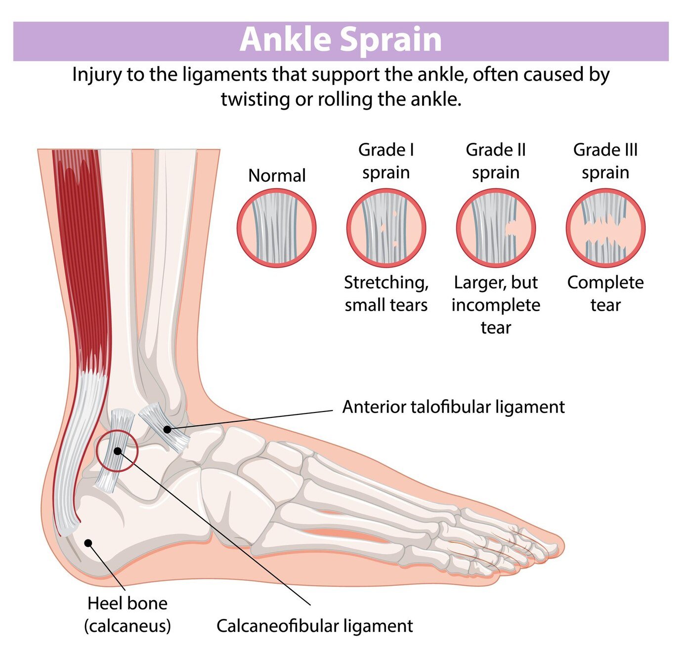 Top 5 Exercises for a Faster Recovery from an Ankle Sprain